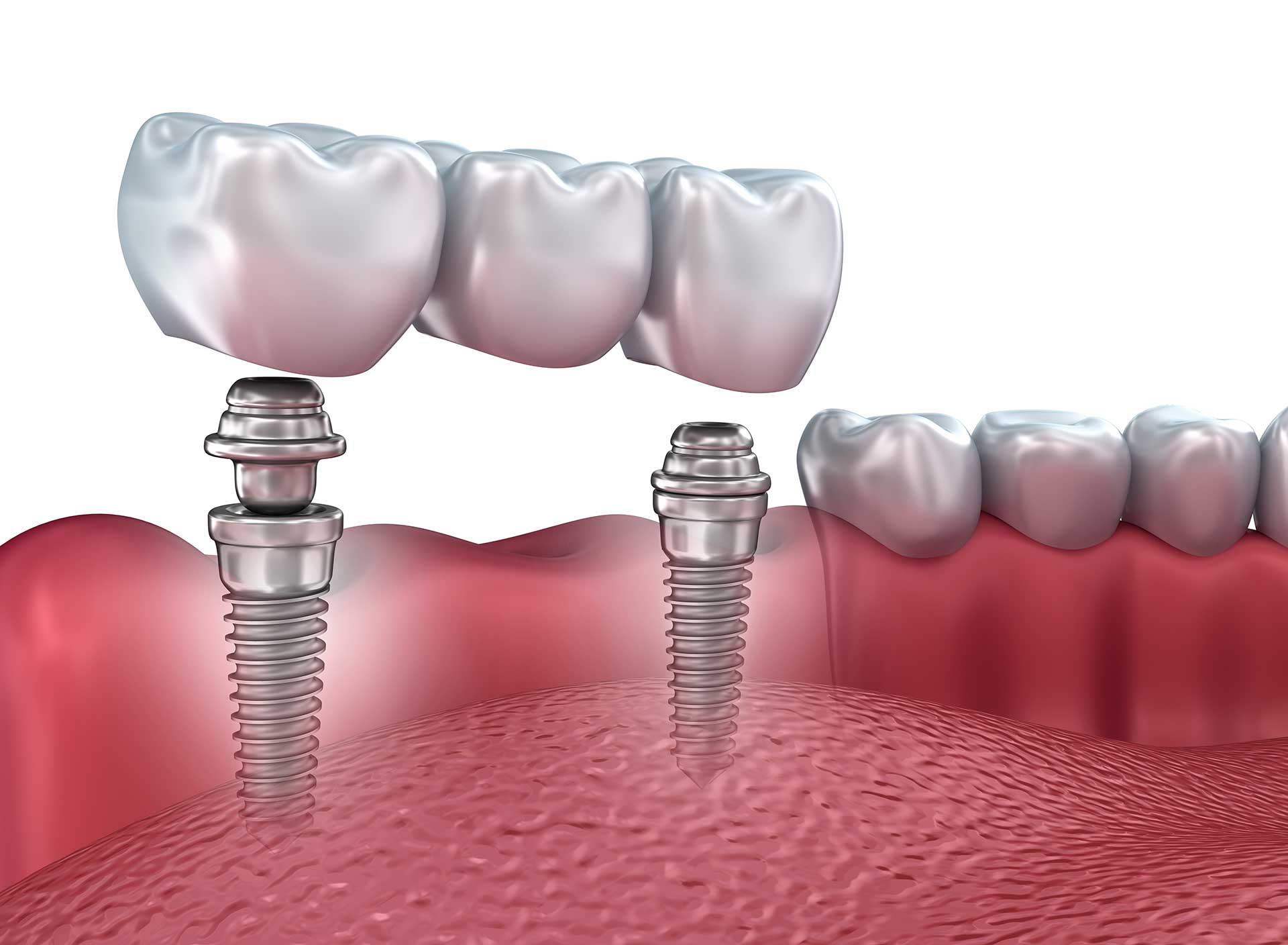 All About Implant Restorations | Haider Family Dentistry